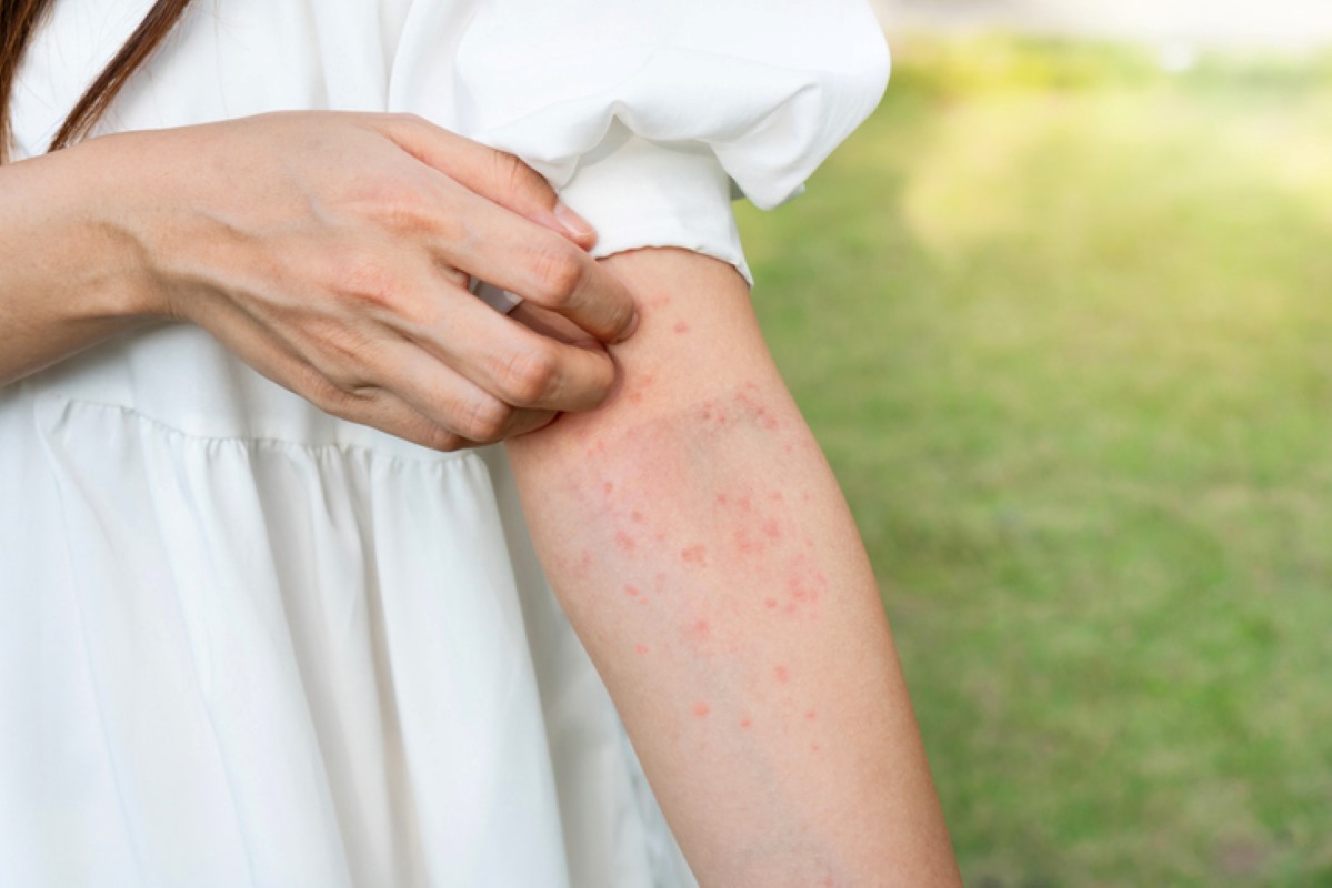 How To Identify Different Bug Bites and Treat Them - Rove Pest Control